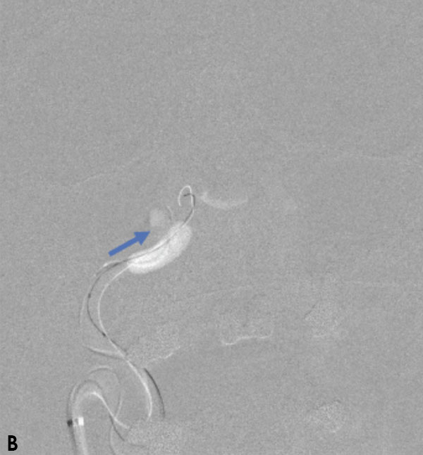 Carotid Cavernous Fistula (CCF) | NSPC Brain & Spine Surgery